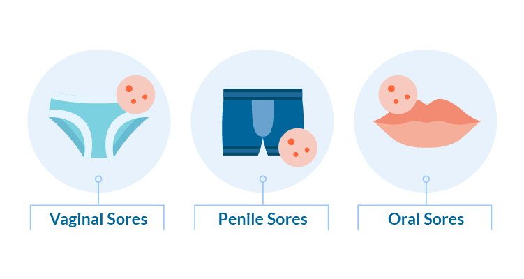 STD Sores | Priority STD